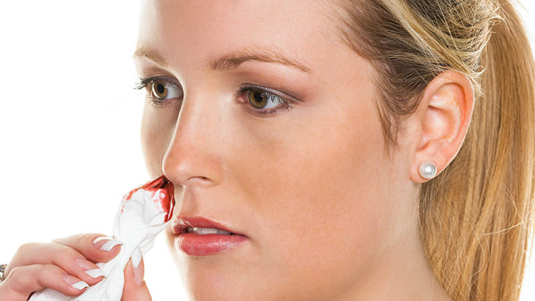 Qué es la Epistaxis Nasal y Cuál es su Tratamiento - Consultas Otorrino